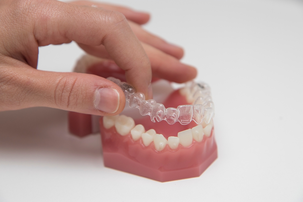 Our Vancouver Dentists Explain How Invisalign Works